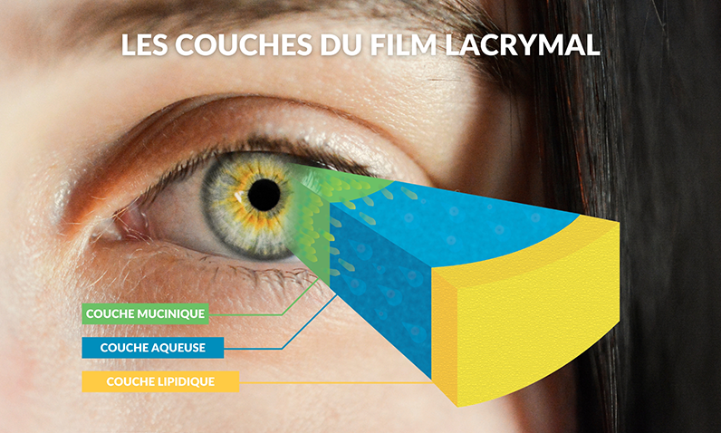 Sécheresse oculaire par insuffisance aqueuse vs sécheresse oculaire ...